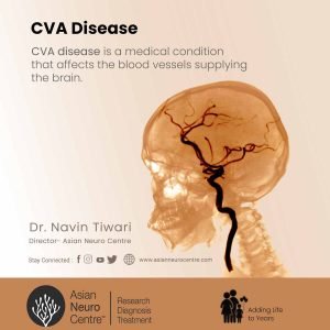 What is Cerebrovascular Accident (CVA) Disease, Symptoms, Causes, Treatment